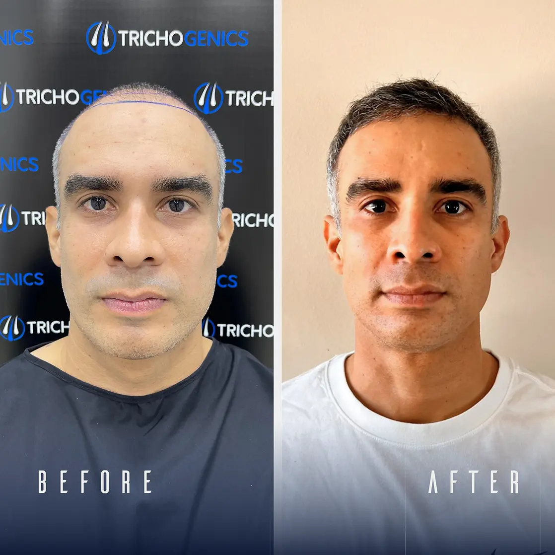 How Successful Are Hair Transplants